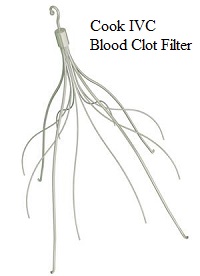 Cook Medical loses $1.2 Million IVC Filter Verdict