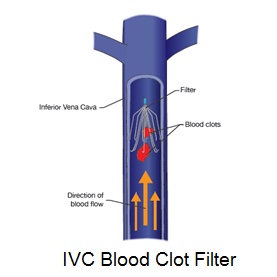 New Laser Technique removes IVC Filters
